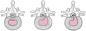 Protrusão discal: causas, sintomas e tratamento. - CMT Clínica da dor
