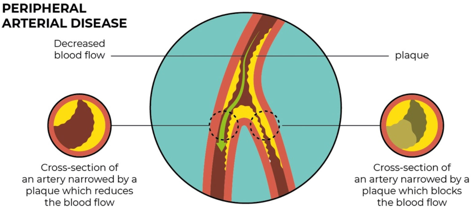 Trombose - CMT Clínica da dor